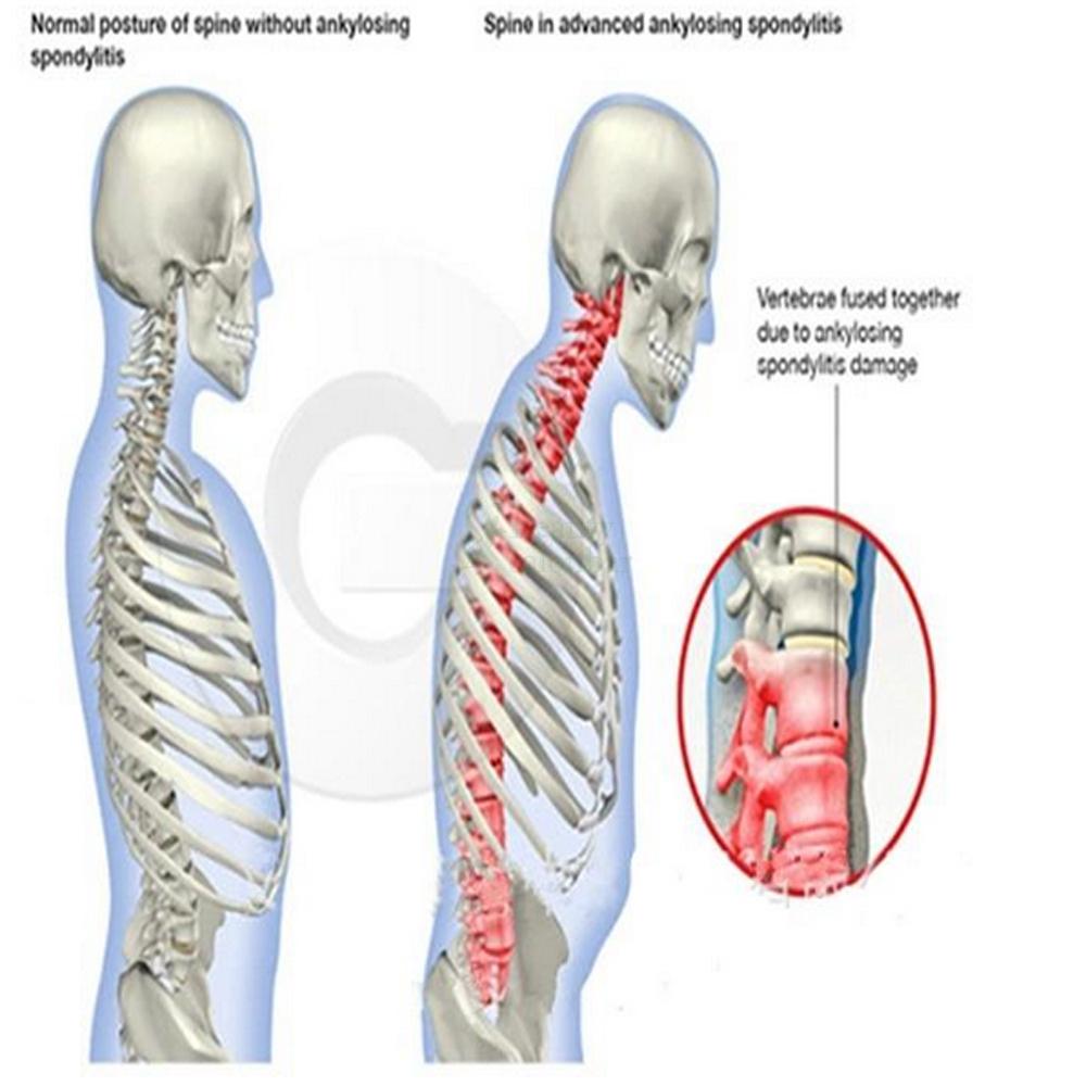 Hunchback Kyphosis Posture Correction Belt Magnetic Unisex Back Support ...